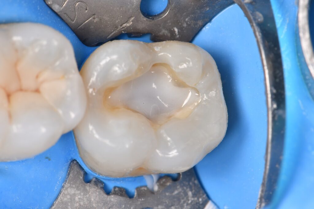 Composite Layering Protocol for Lower Second Molar