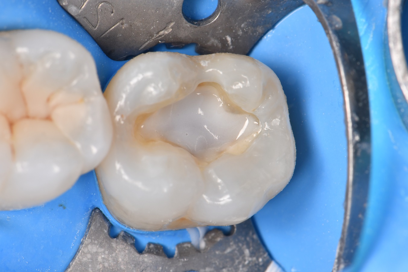 Composite Layering Protocol for Lower Second Molar