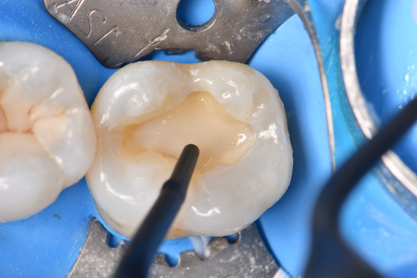 Composite Layering Protocol for Lower Second Molar