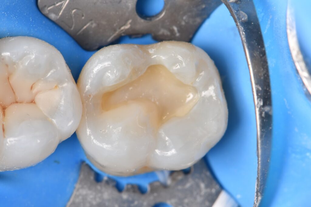 Composite Layering Protocol for Lower Second Molar