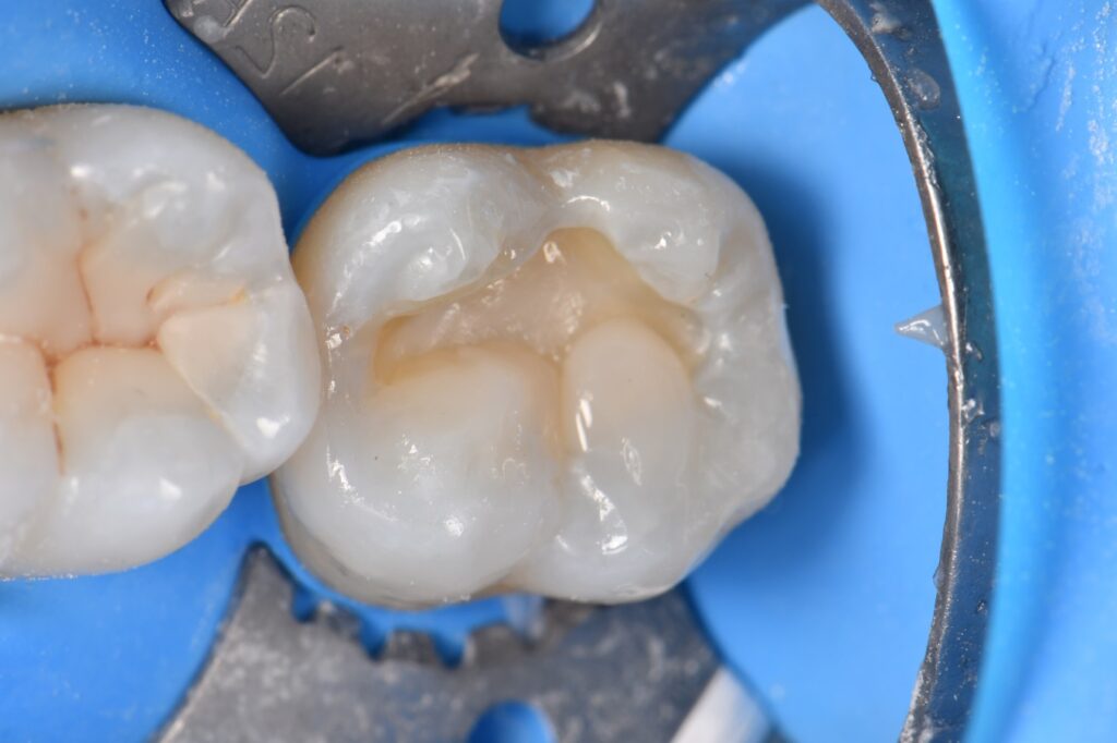 Composite Layering Protocol for Lower Second Molar