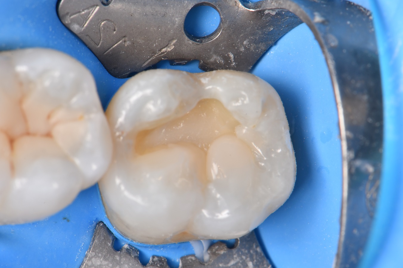 Composite Layering Protocol for Lower Second Molar