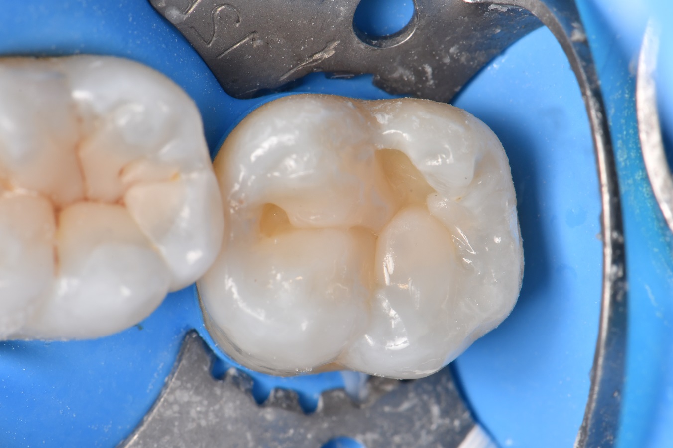 Composite Layering Protocol for Lower Second Molar