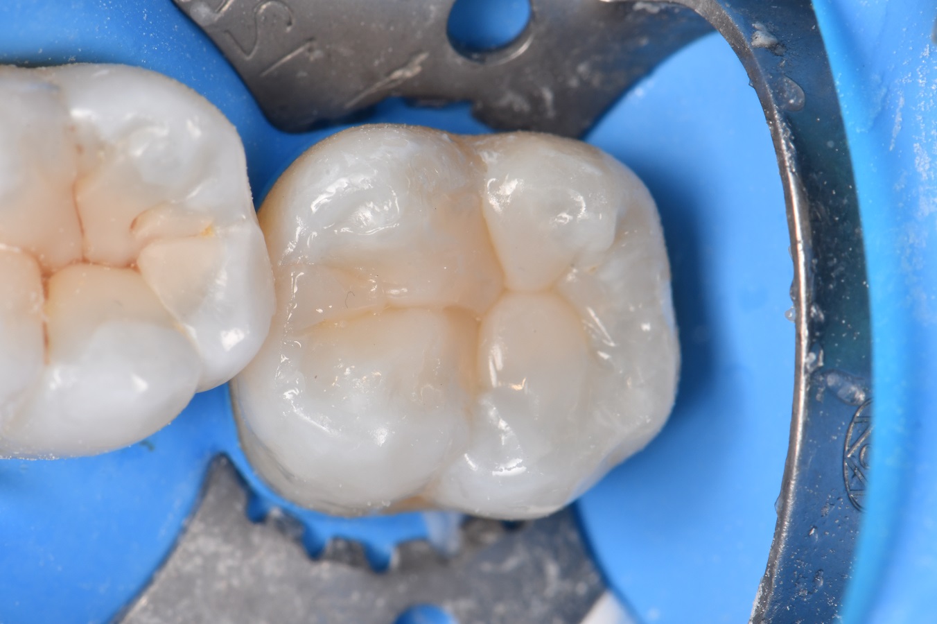 Composite Layering Protocol for Lower Second Molar