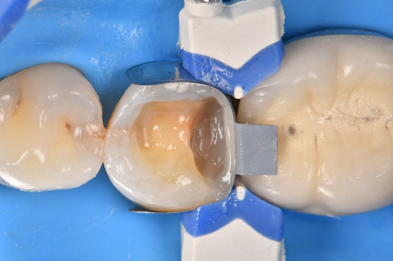 Class II direct resin workflow