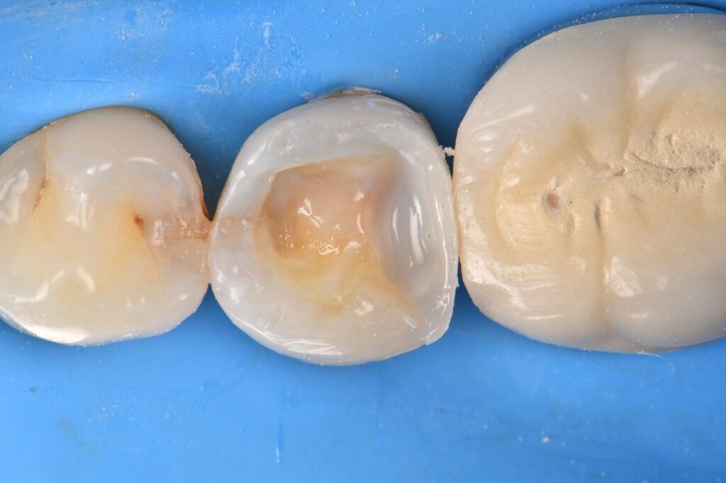Class II direct resin workflow