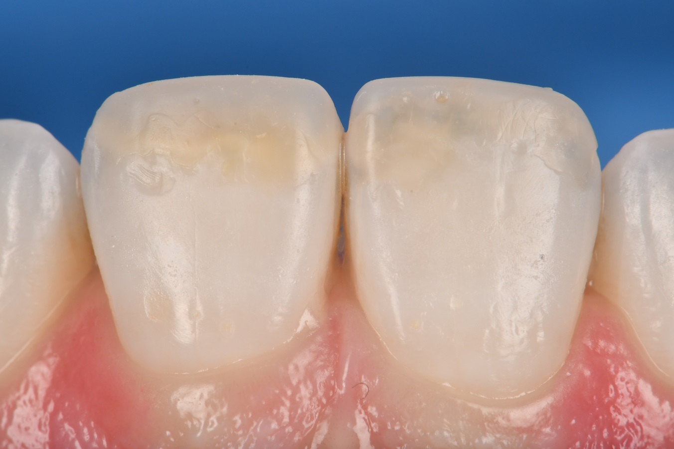 Complex Composite Restorations with Seamless Transitions