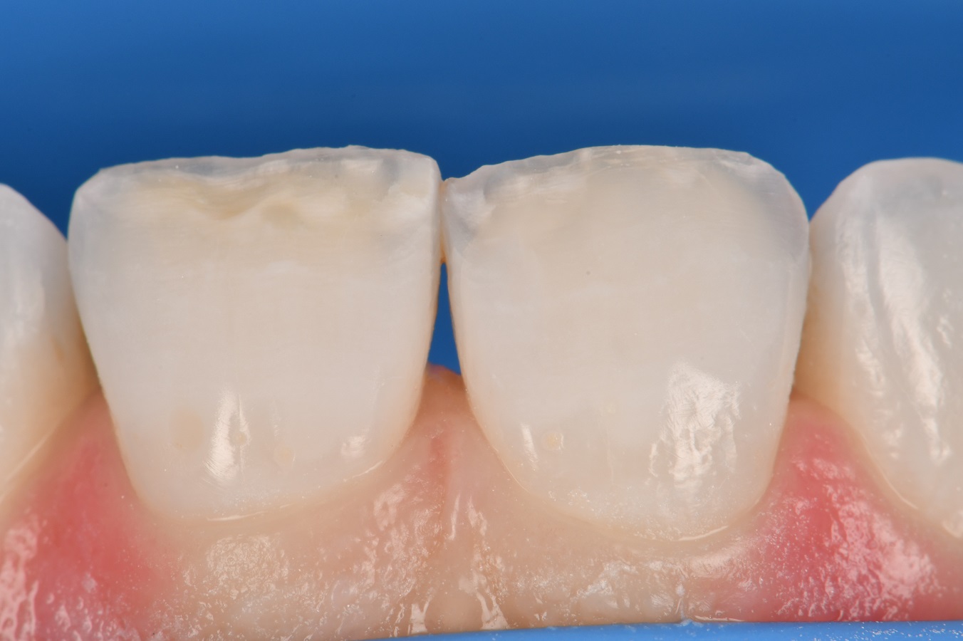 Complex Composite Restorations with Seamless Transitions