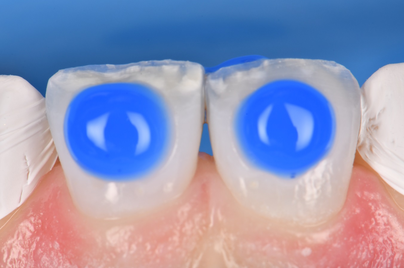 Complex Composite Restorations with Seamless Transitions