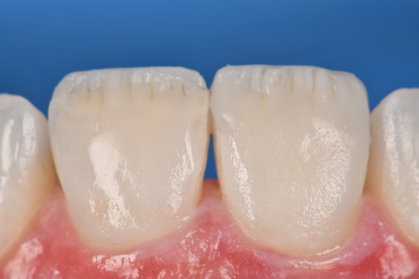 Complex Composite Restorations with Seamless Transitions