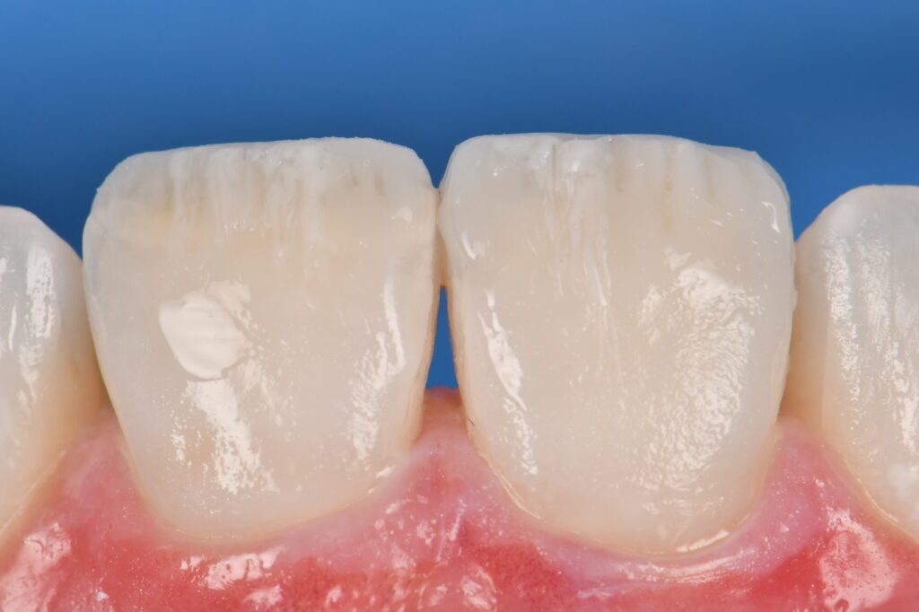 Complex Composite Restorations with Seamless Transitions