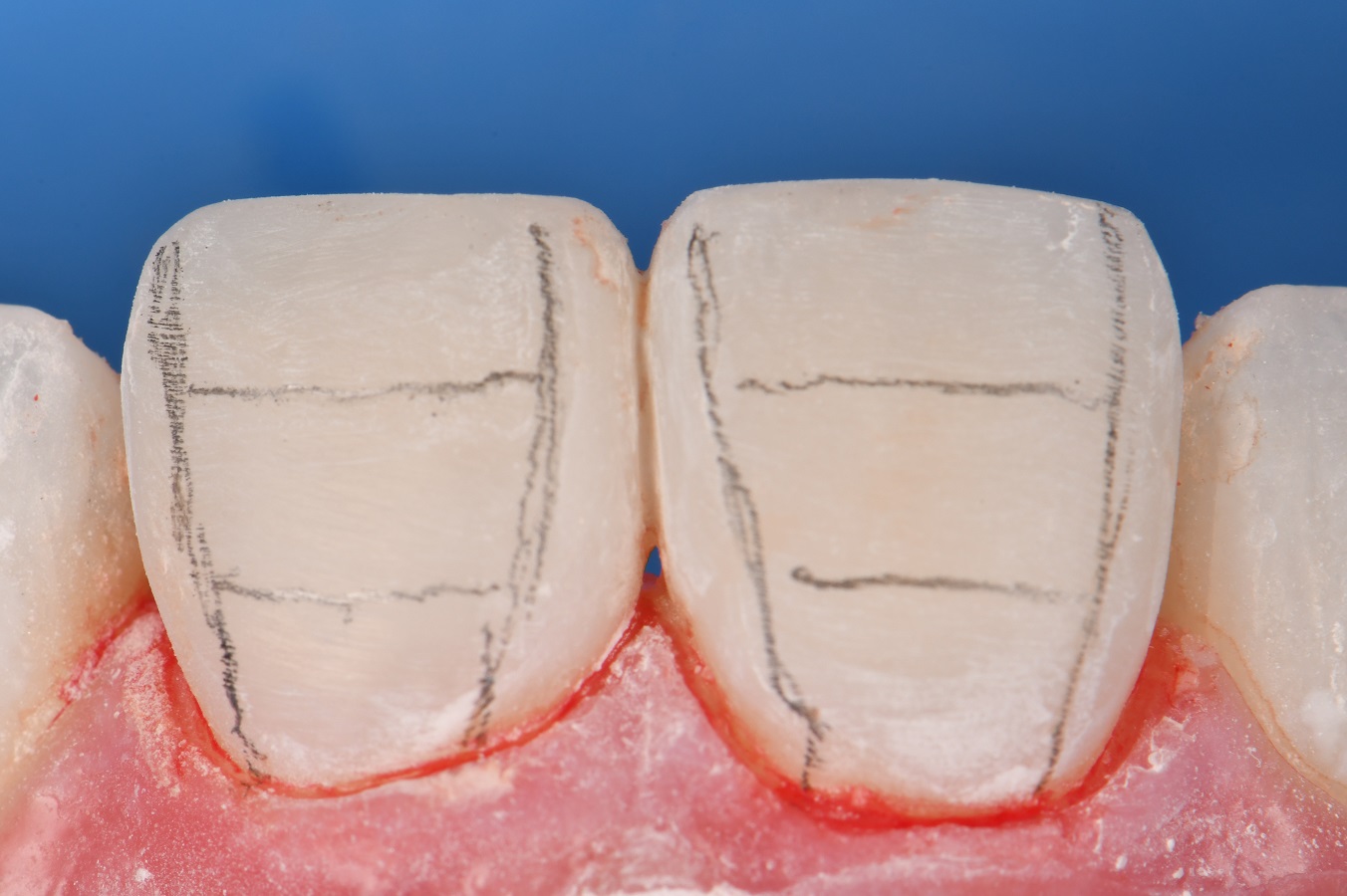 Complex Composite Restorations with Seamless Transitions