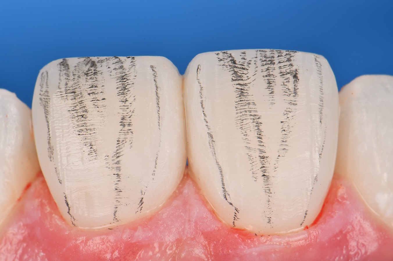 Complex Composite Restorations with Seamless Transitions