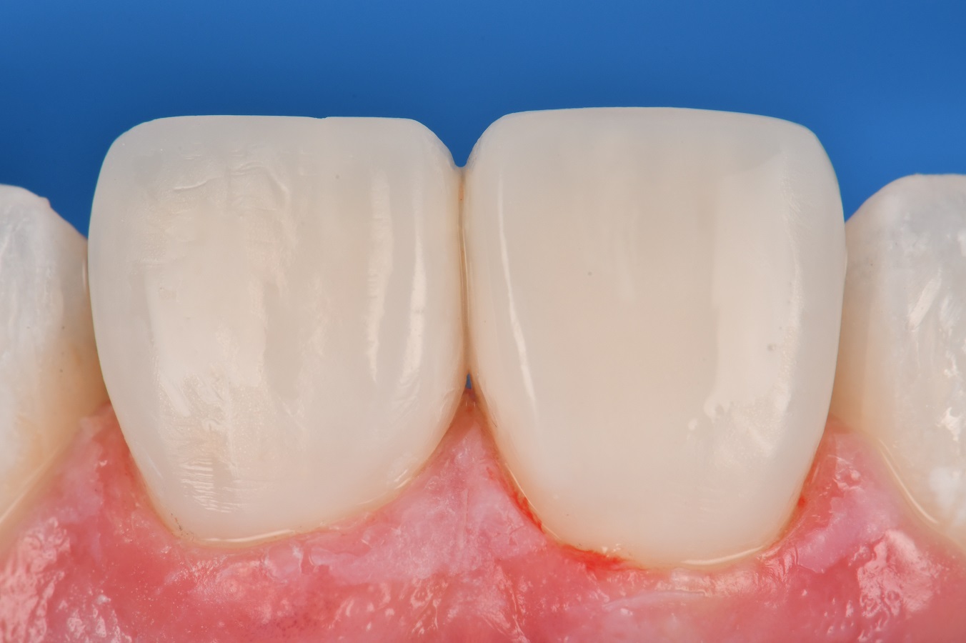 Complex Composite Restorations with Seamless Transitions