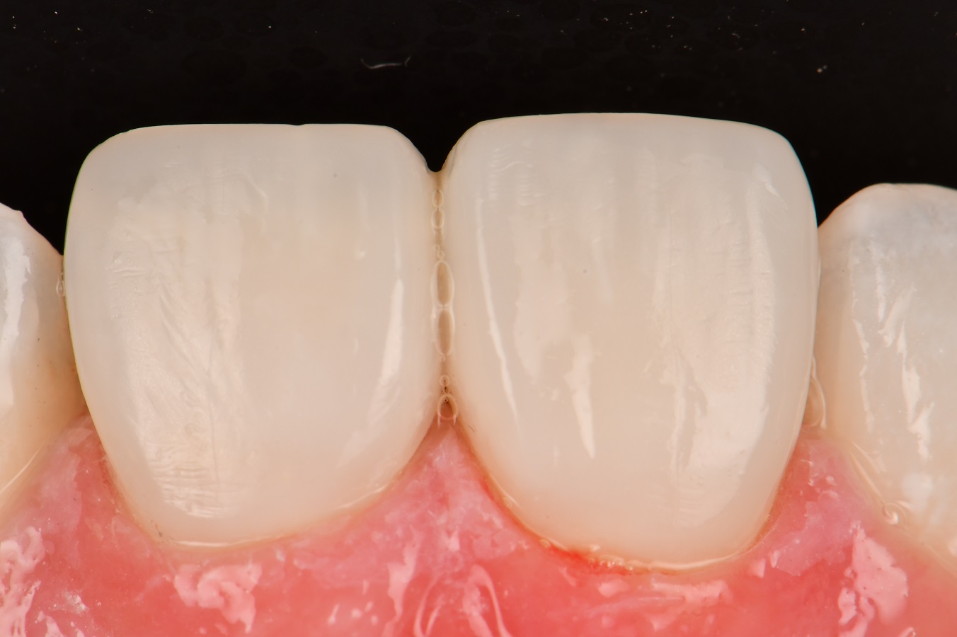 Complex Composite Restorations with Seamless Transitions