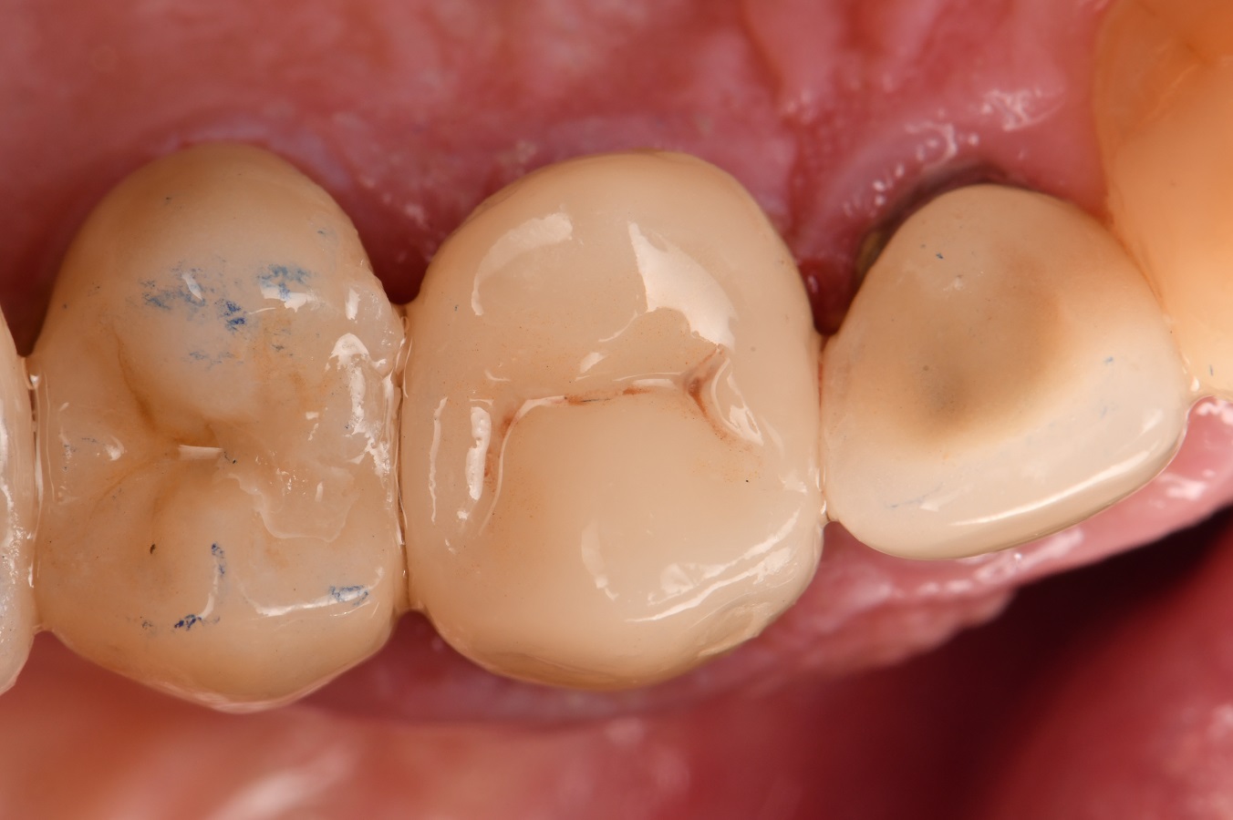 Crown Leakage and Replacement with new bonded porcelain crown