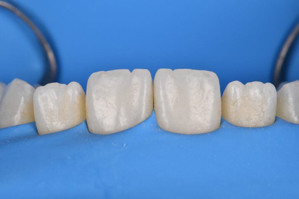 Layering of Partial Composite Veneers to derotate teeth