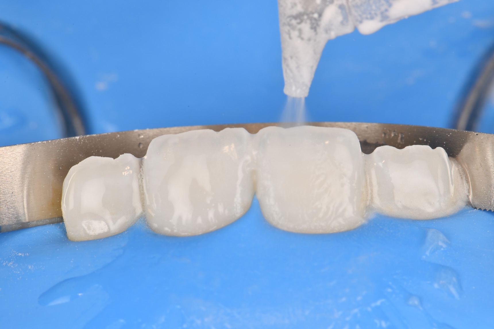 Layering of Partial Composite Veneers to derotate teeth