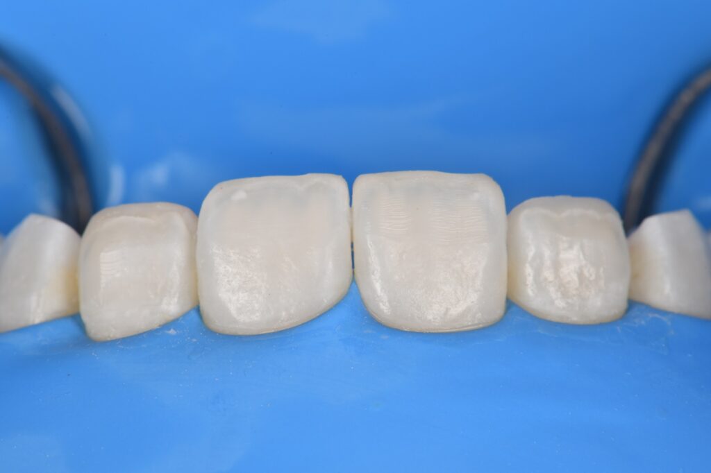 Layering of Partial Composite Veneers to derotate teeth
