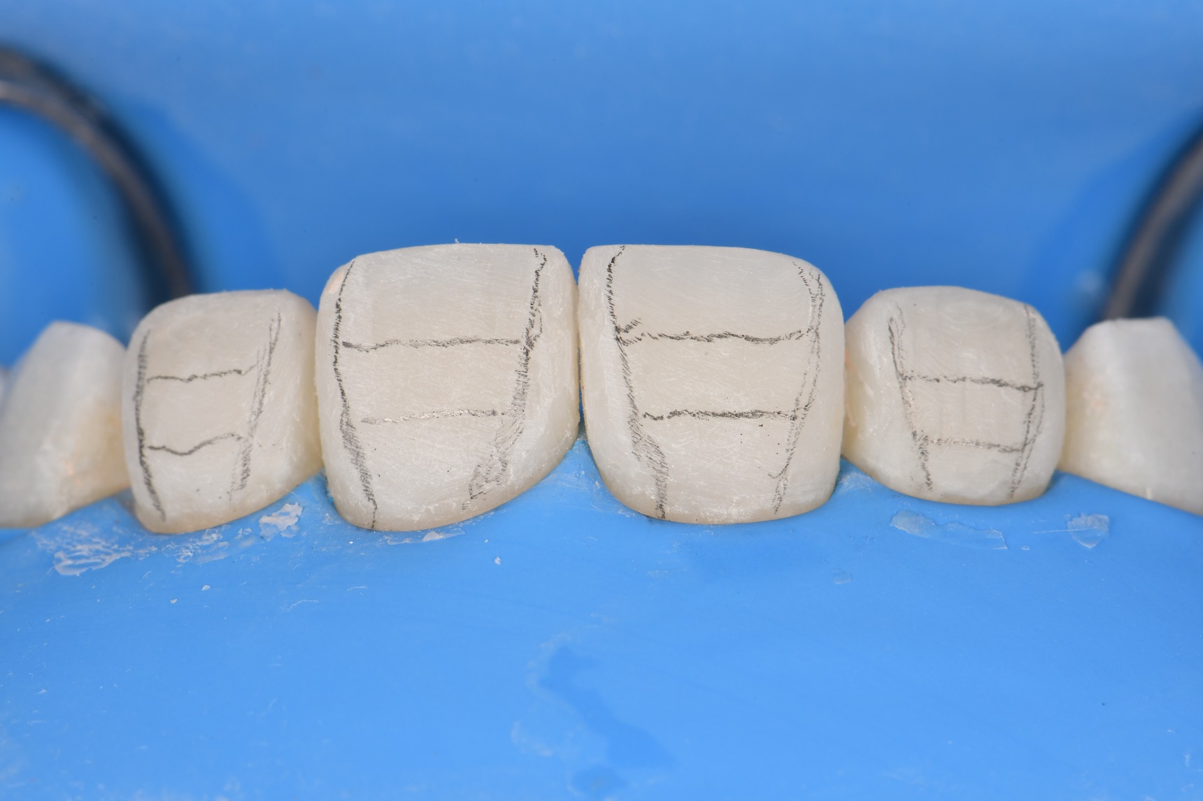 Layering of Partial Composite Veneers to derotate teeth