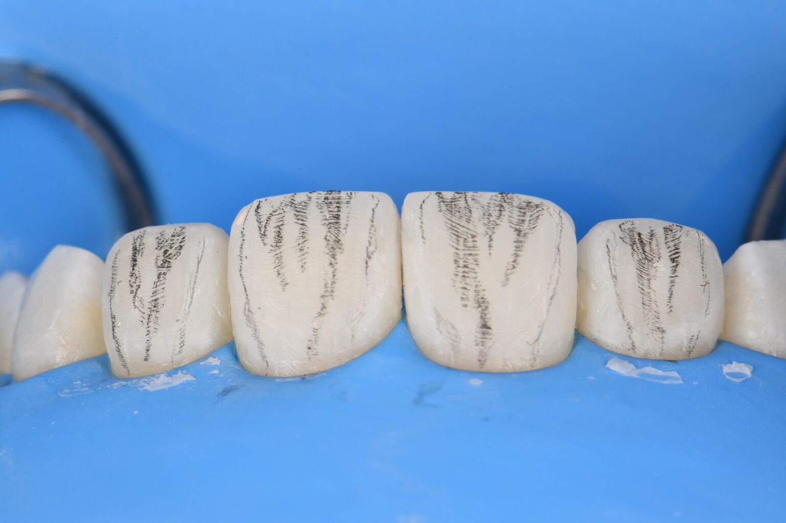 Layering of Partial Composite Veneers to derotate teeth