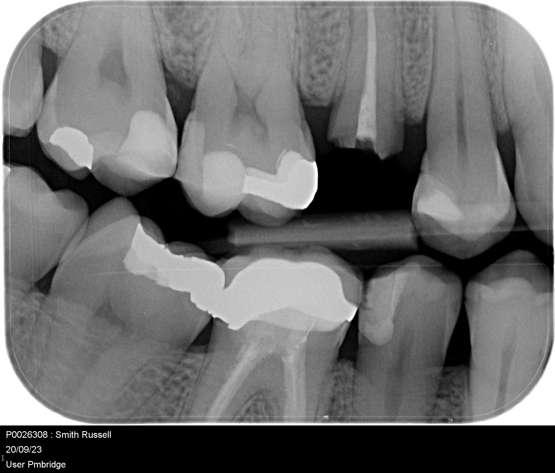 Dental Heroics Ferrule increase via crown lengthening on a bicuspid