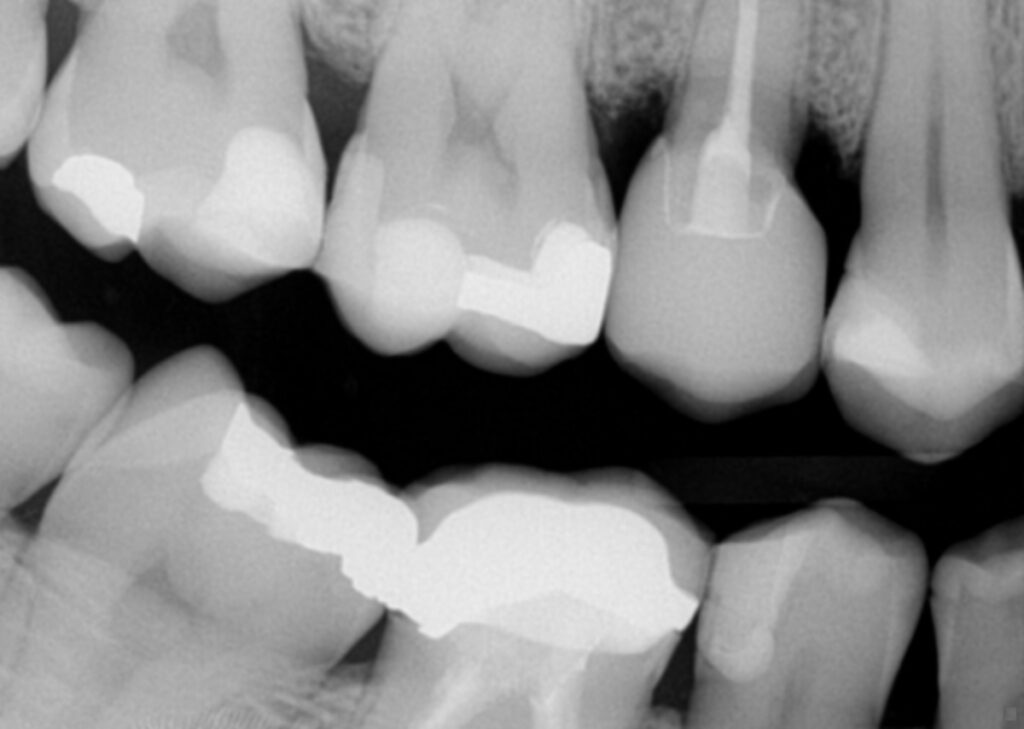 Dental Heroics Ferrule increase via crown lengthening on a bicuspid