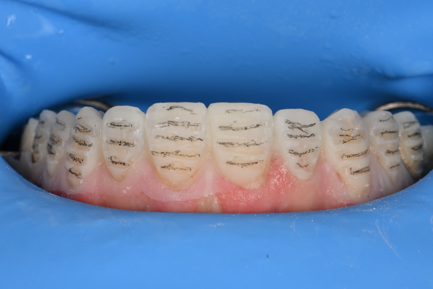Digital Smile Design-driven Esthetic reconstruction