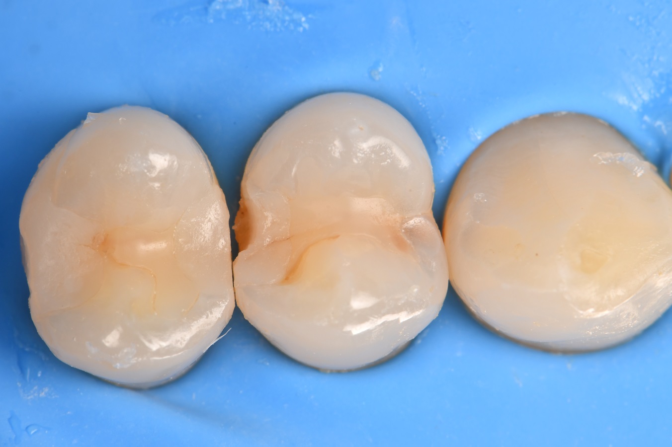 Building up a MOD restoration on a bicuspid