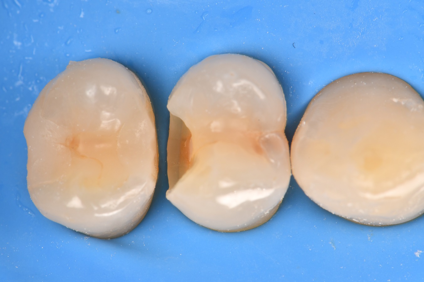 Building up a MOD restoration on a bicuspid