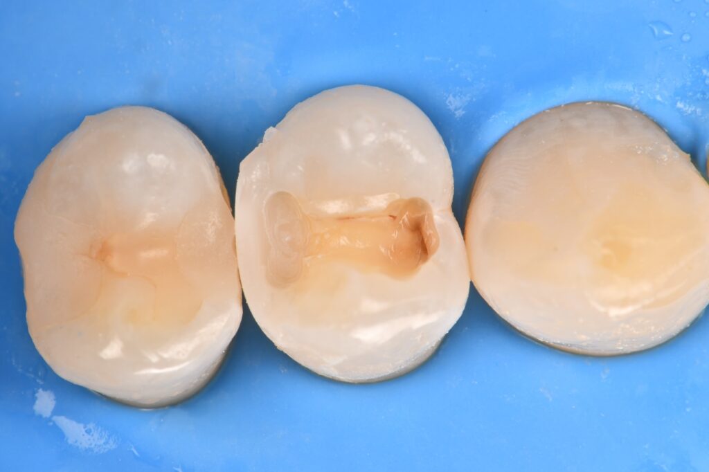 Building up a MOD restoration on a bicuspid