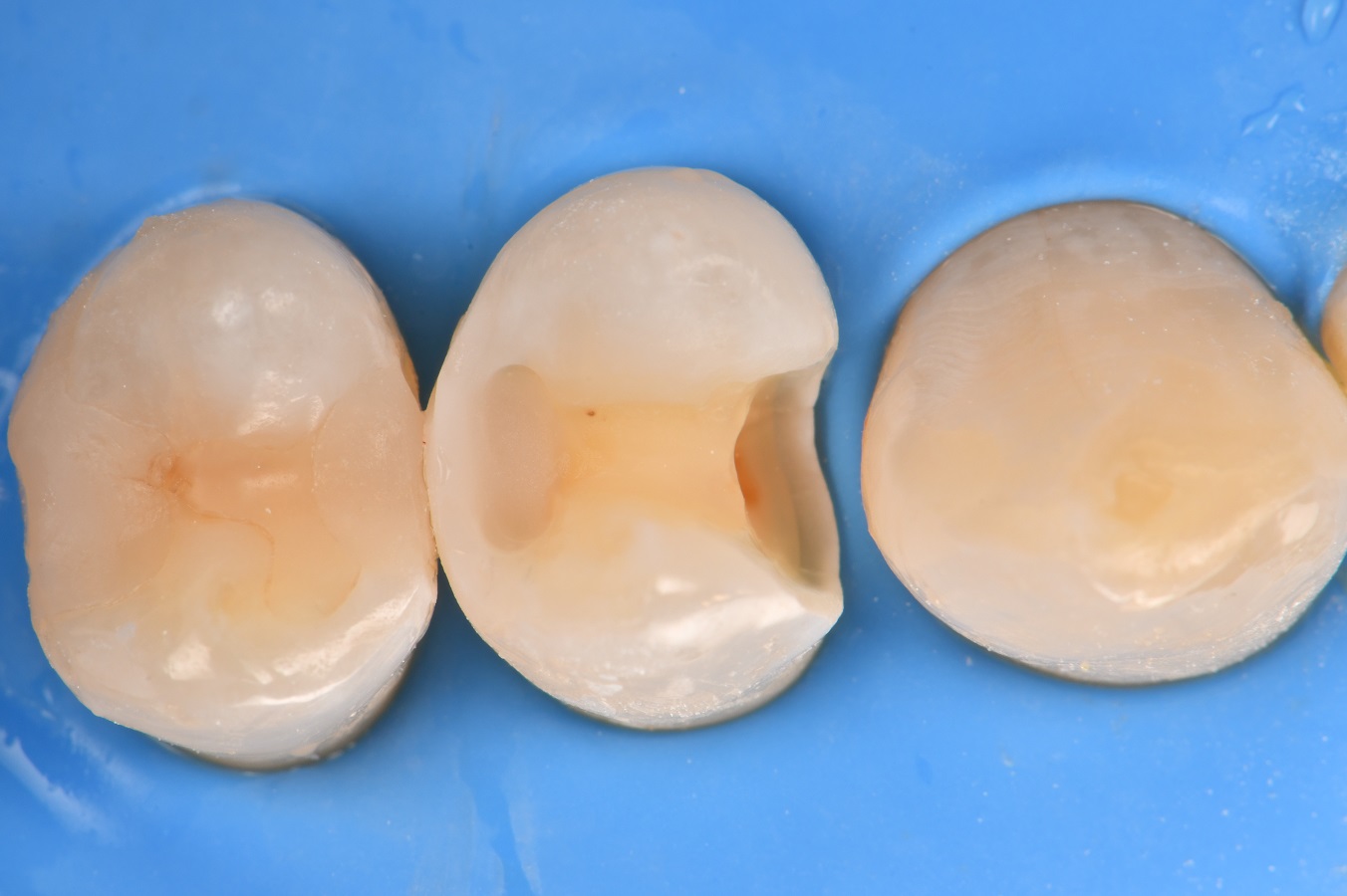 Building up a MOD restoration on a bicuspid