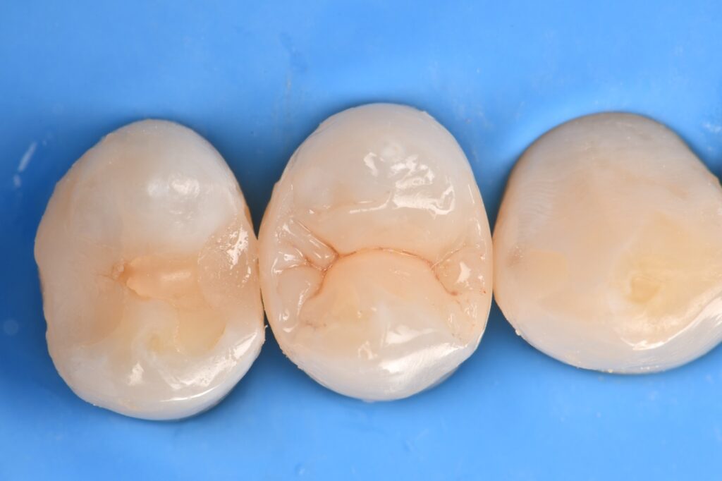 Building up a MOD restoration on a bicuspid