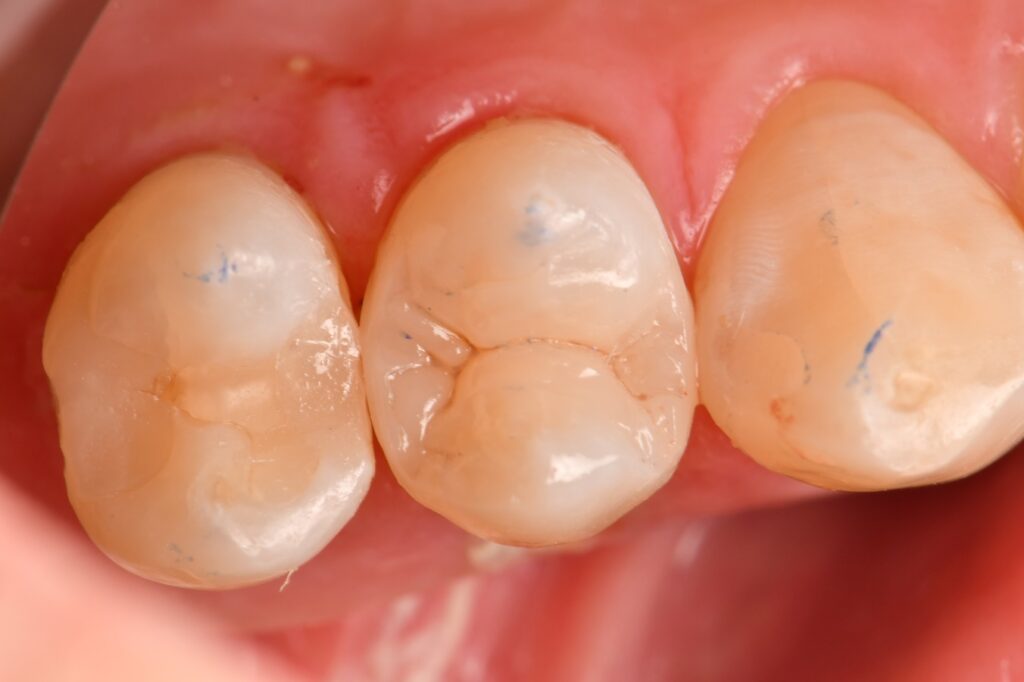 Building up a MOD restoration on a bicuspid