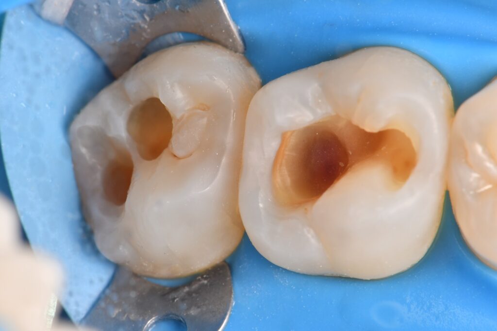 GC Gaenial Achord and Ever-X Flow synergy in biomimetic dentistry