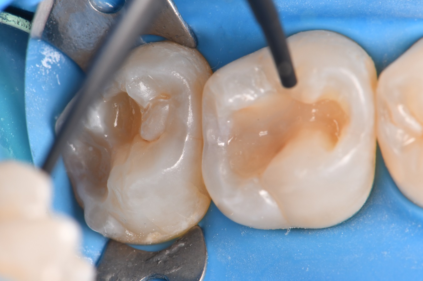 GC Gaenial Achord and Ever-X Flow synergy in biomimetic dentistry