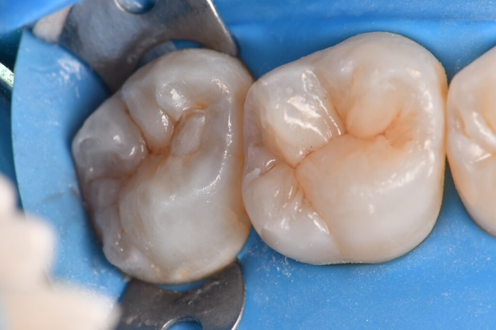 GC Gaenial Achord and Ever-X Flow synergy in biomimetic dentistry