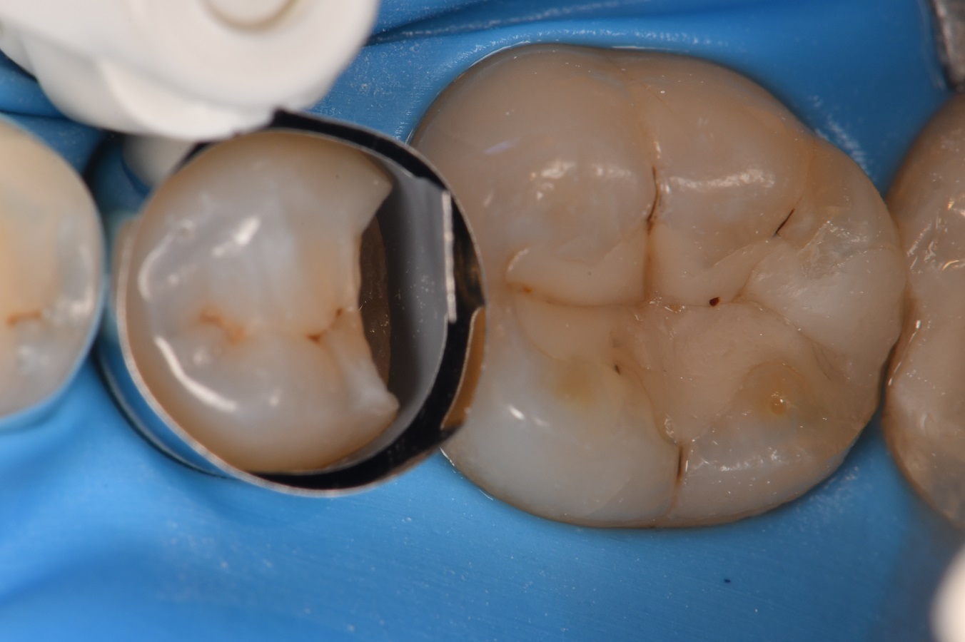 Slot Preps restored with a chameleon supercomposite