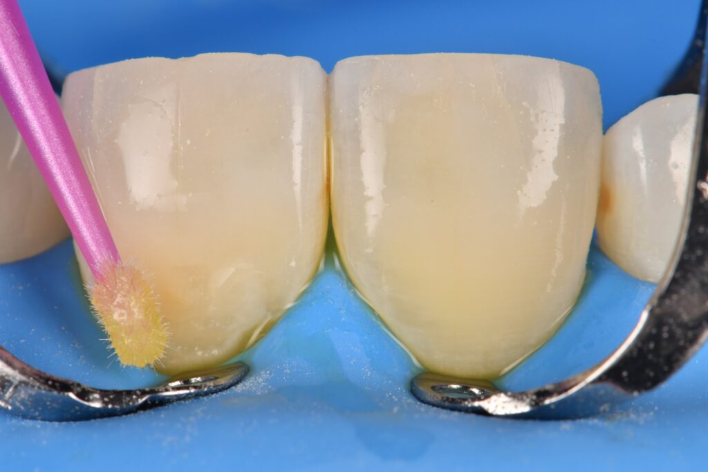 Rinse and Repeat – a protocol for restoring shear bond strength with ...