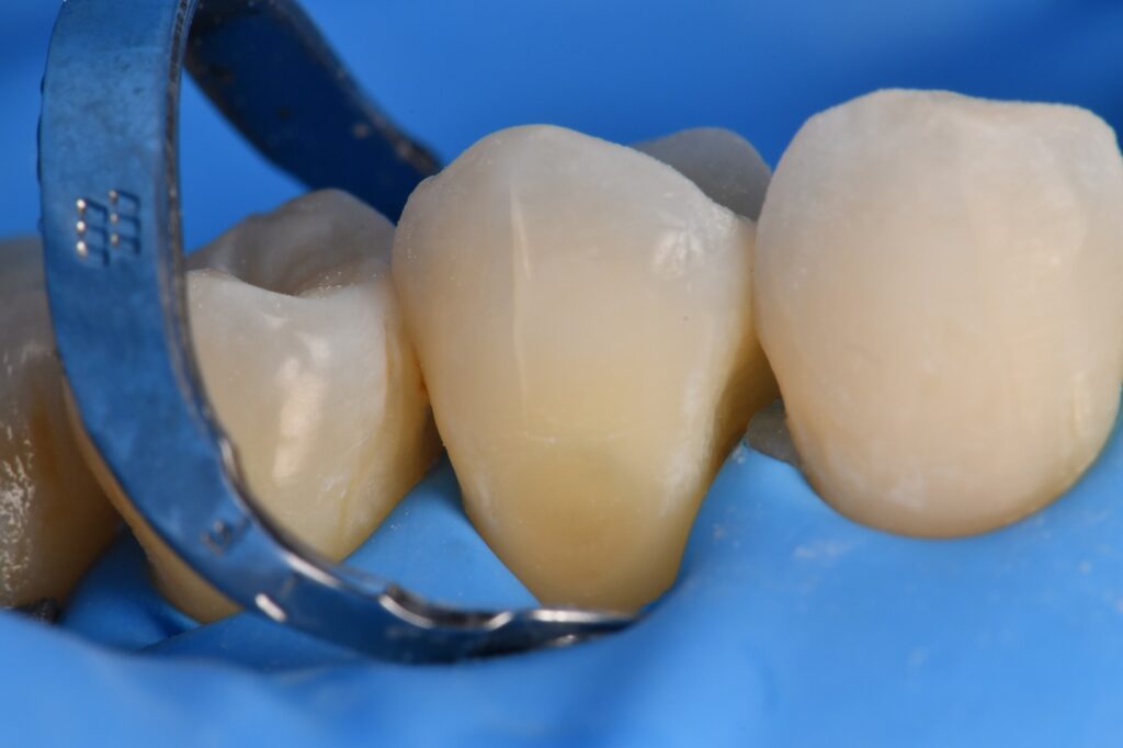 Rinse and Repeat – a protocol for restoring shear bond strength with ...