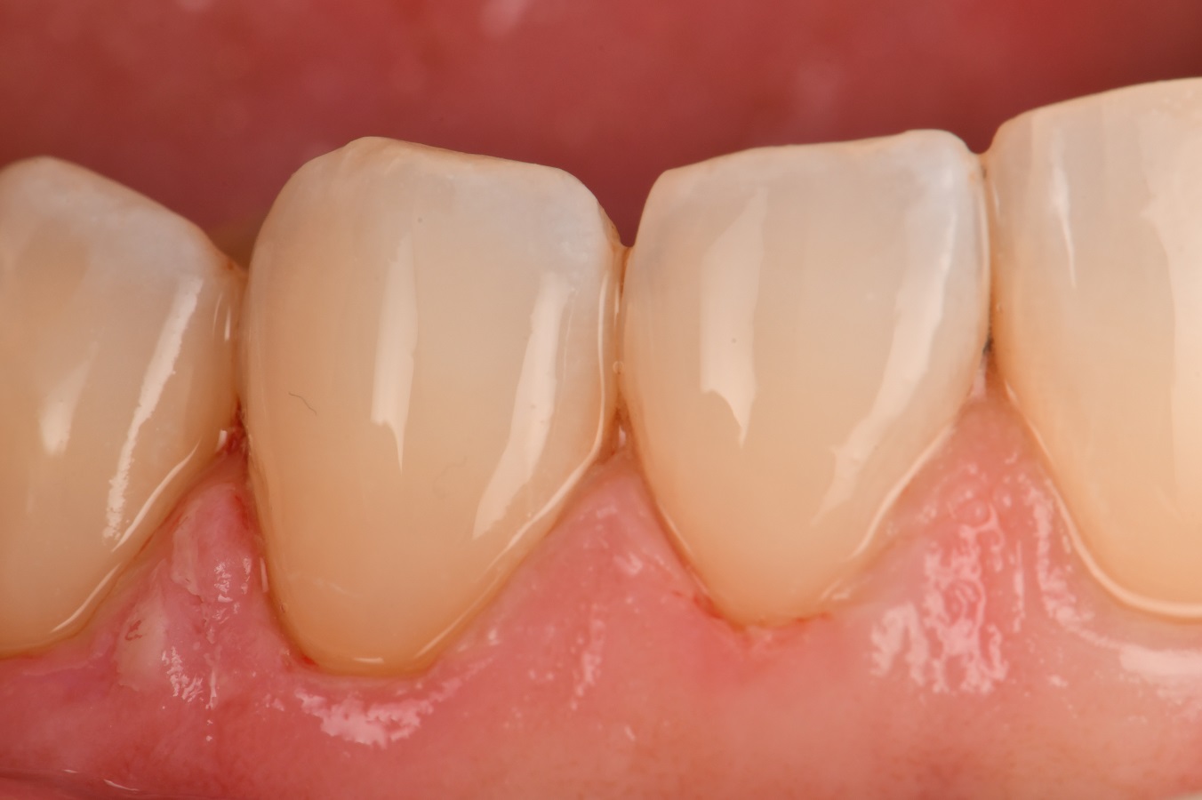 Rinse and Repeat – a protocol for restoring shear bond strength with ...