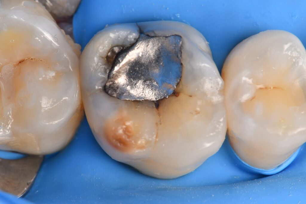 Amalgam replacement and dentin replacement with Ever-X Flow