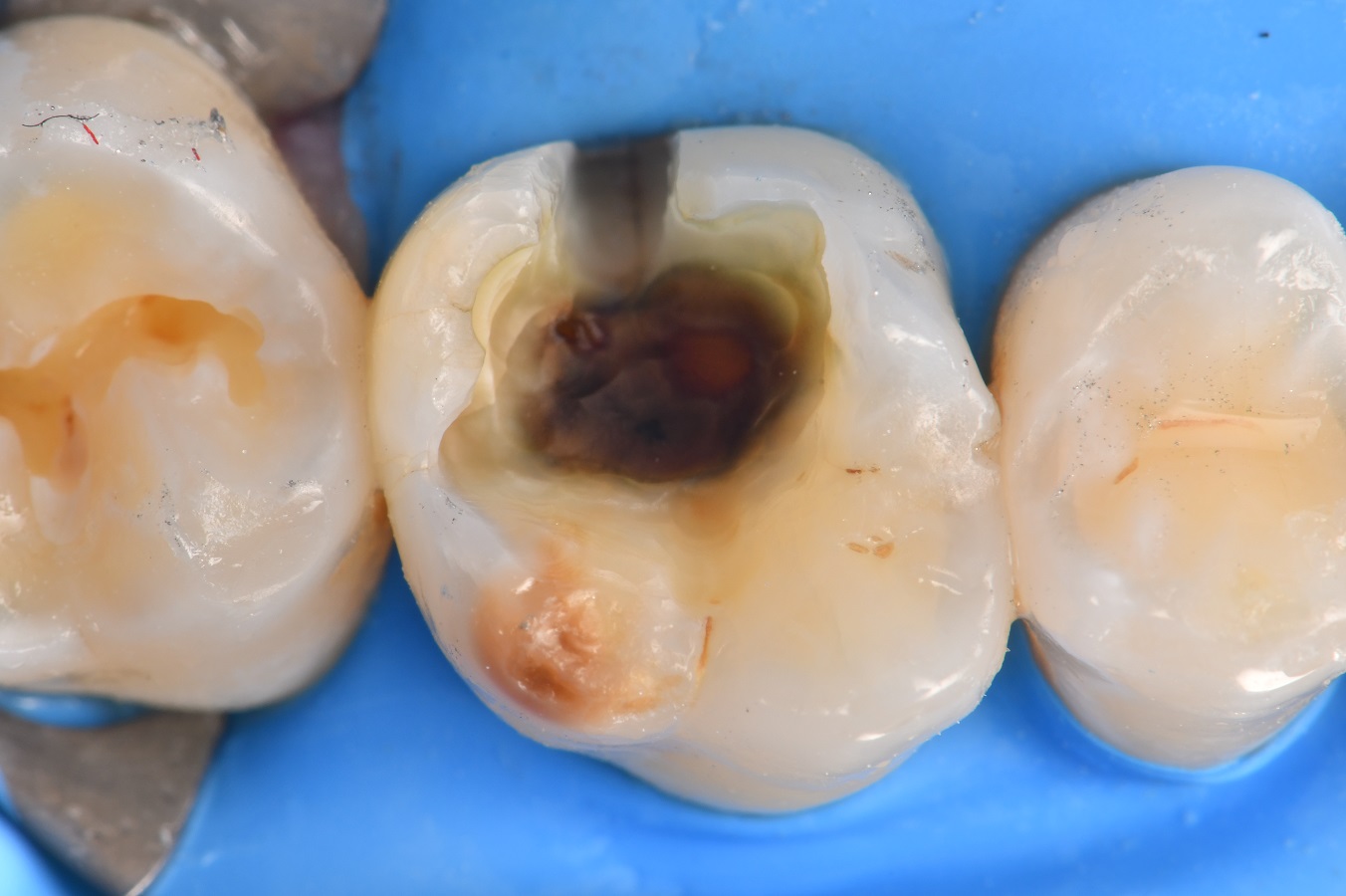 Amalgam replacement and dentin replacement with Ever-X Flow
