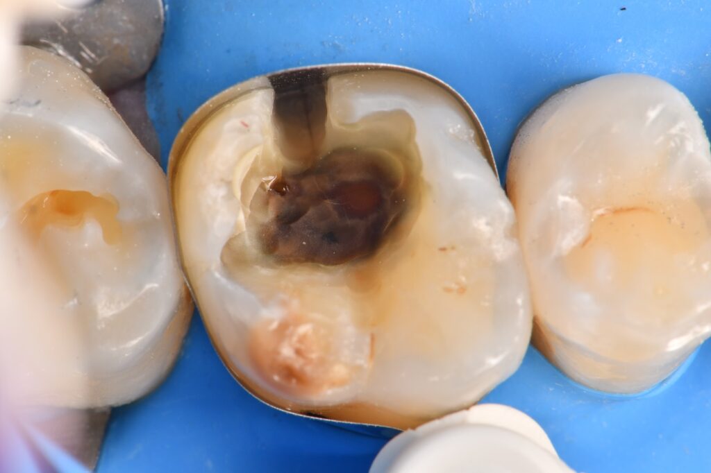 Amalgam replacement and dentin replacement with Ever-X Flow