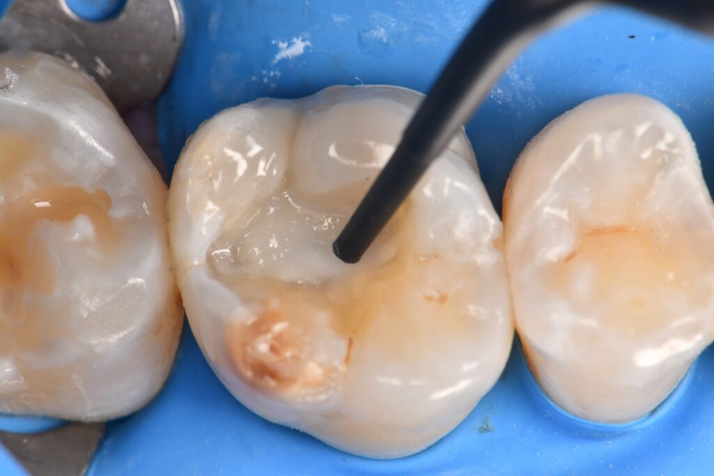 Amalgam replacement and dentin replacement with Ever-X Flow