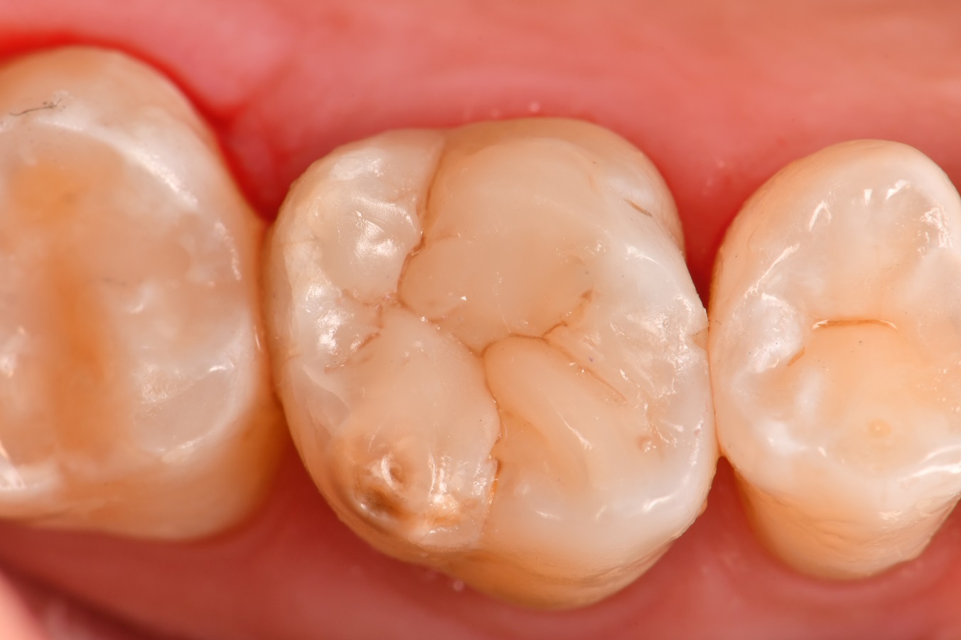 Amalgam replacement and dentin replacement with Ever-X Flow
