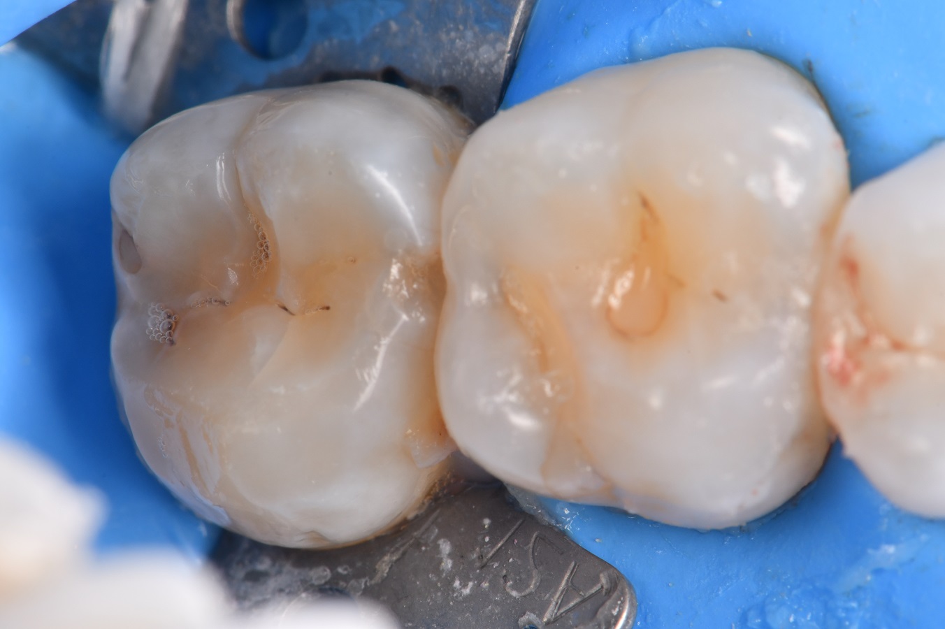 Deep Class II cavity requiring DME and rubber dam clamp change