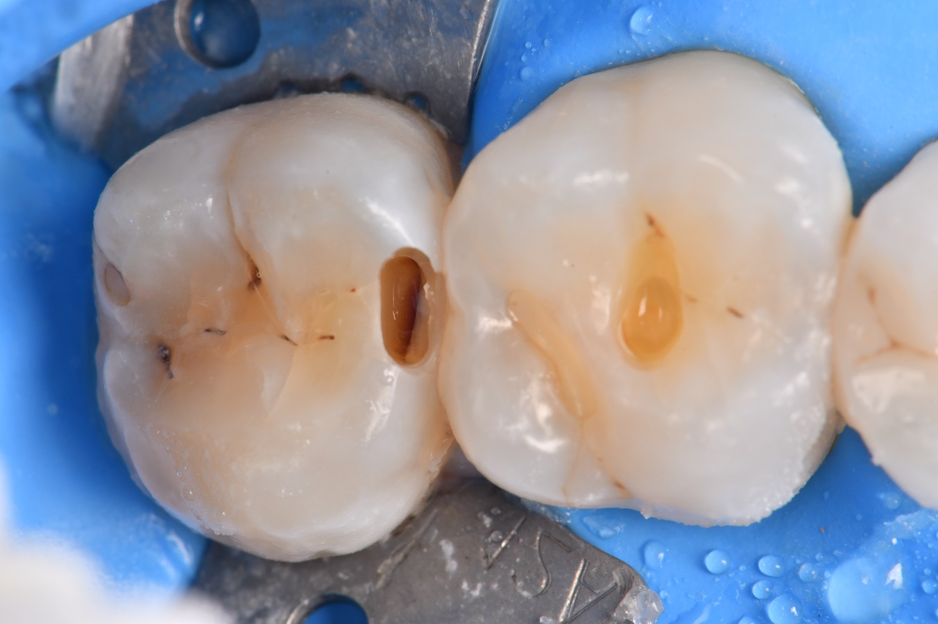 Deep Class II cavity requiring DME and rubber dam clamp change