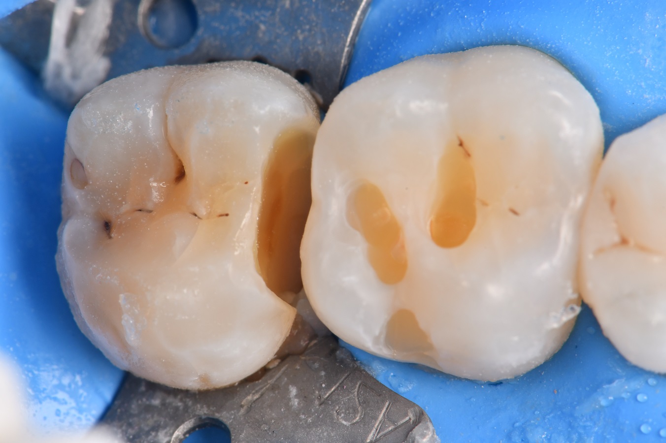 Deep Class II cavity requiring DME and rubber dam clamp change