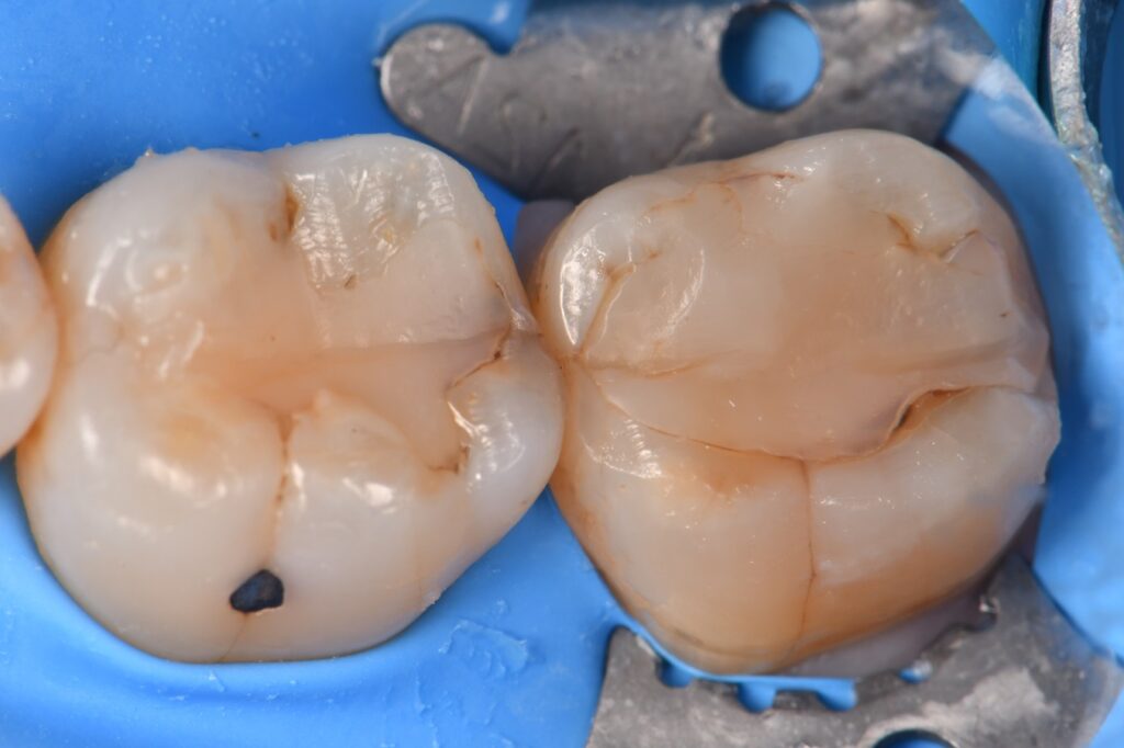 Fissure anatomy on a lower second molar